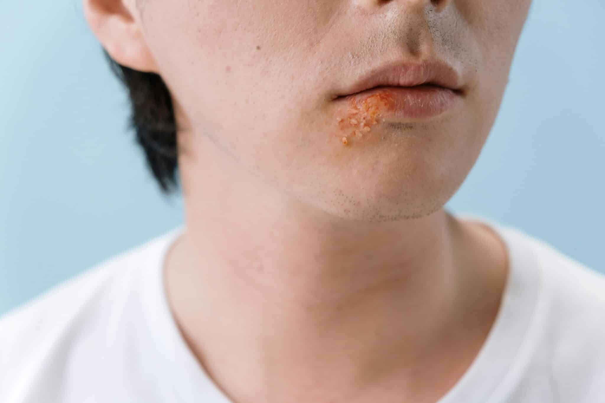 What Causes Meth Face? What Meth Face Look Like?