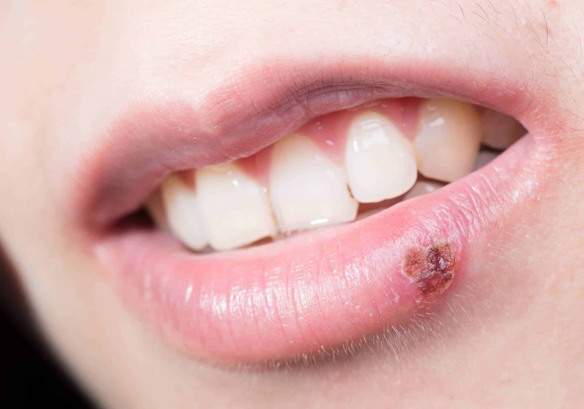 Lisinopril: Uses, Side Effects, Treatment & More