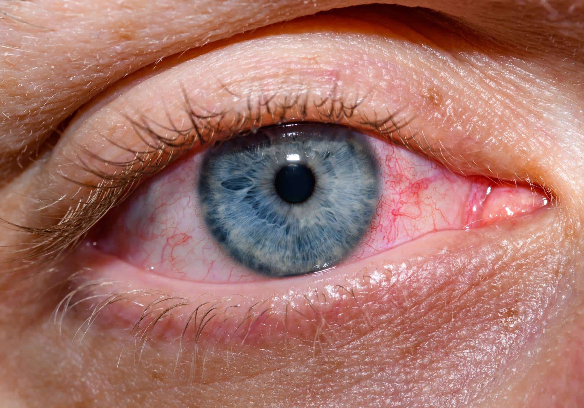 What Is Hash (Hashish)? | Cannabis Addiction Treatment